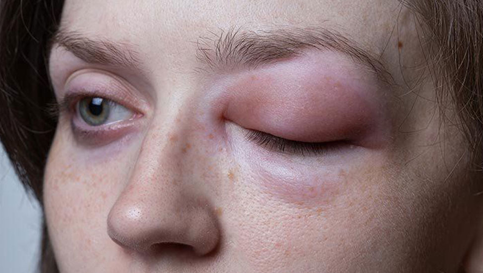 Haei hastalığı nedir? - Doktornumarasi.com